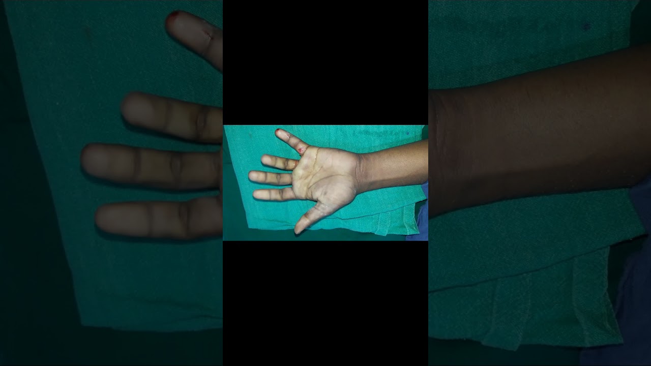Finger tendon examination video showing cascade movement - YouTube