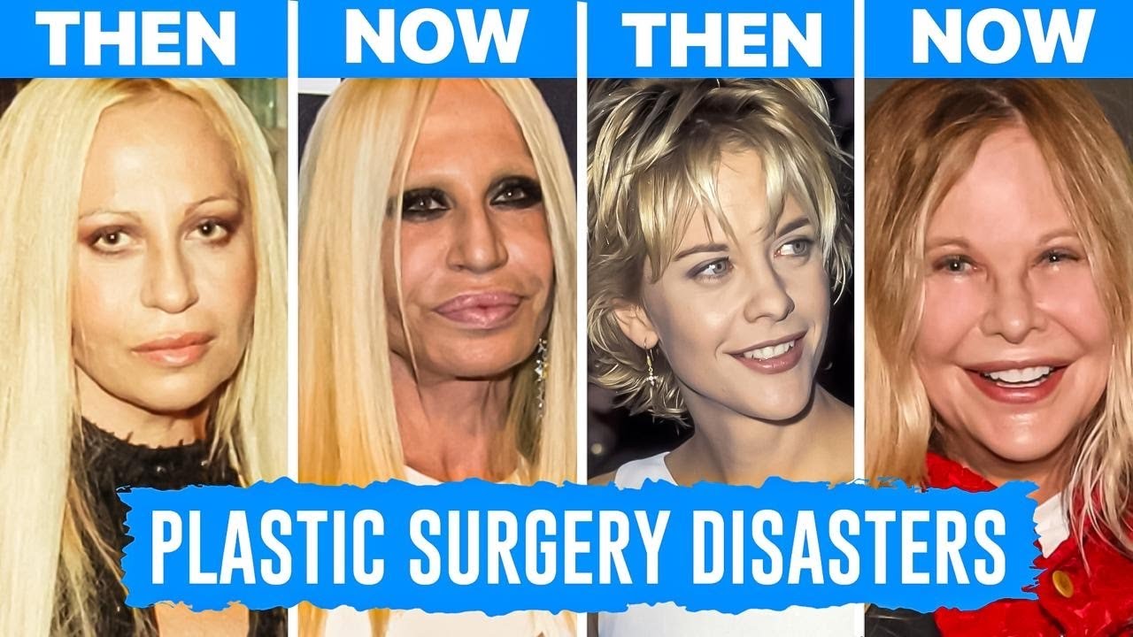 10 Worst Celebrity Plastic Surgery Disasters: Then and Now - YouTube