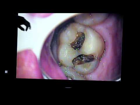 fractured tooth #14 saved from vertical crack - YouTube