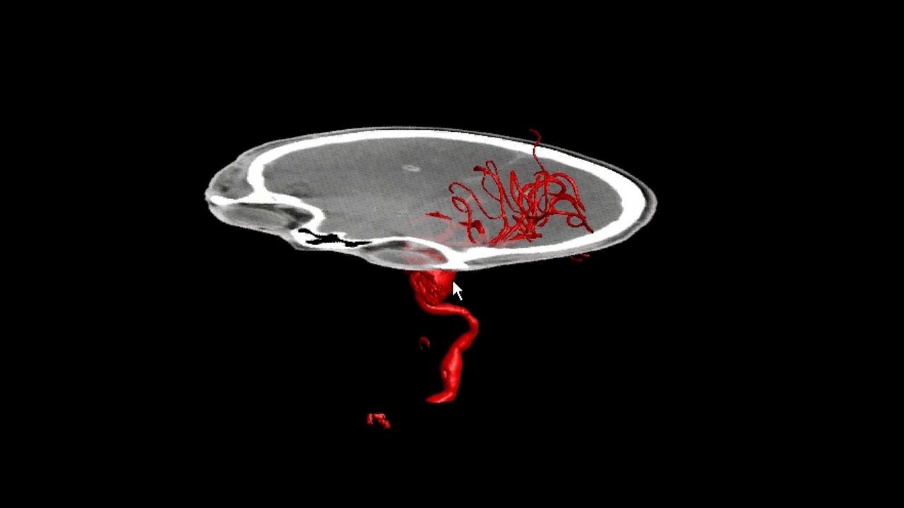 Xper CT 3D-RA Matching - YouTube
