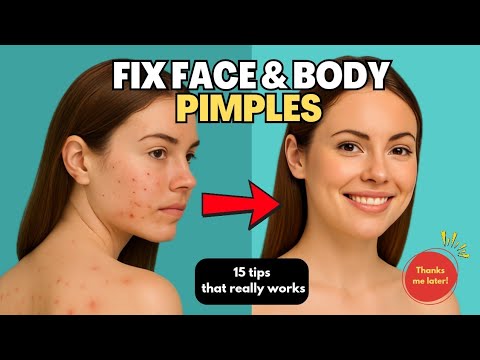 Face, Chest & Back Pimples? 15 Hacks to Clear Your Skin Fast | Thanks ...