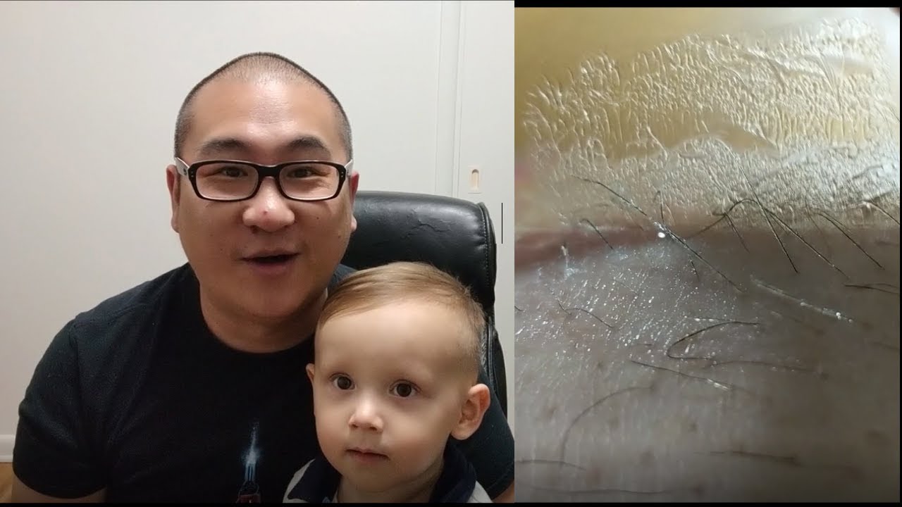 WAX STRIPS AND STICKY FLAKES WITH A TOUCH OF EDGED PICKING [Psoriasis ...