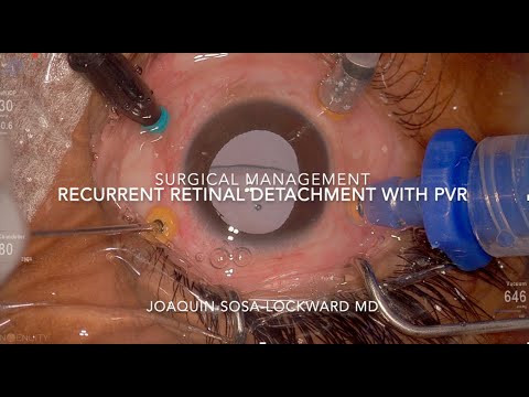 Clip #27- Recurrent Retinal detachment with PVR and inferior ...