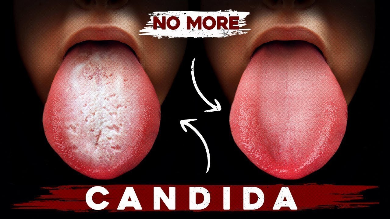 A Better Way to Eliminate Candida for Good - YouTube