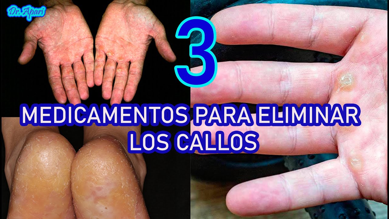 3 Medicamentos para eliminar los callos | Dr. Apari 👨🏻‍⚕️ - YouTube