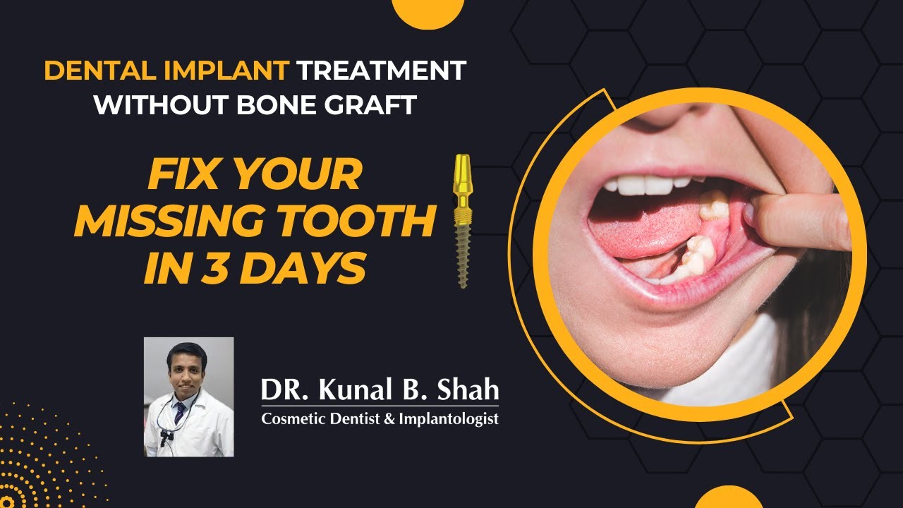 Missing teeth replacement | Implant teeth | Dental Implants before and after | Dr Kunal Shah ...