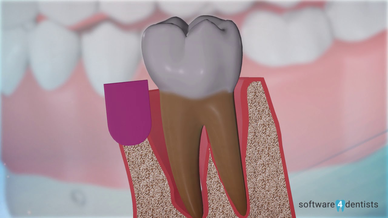 Perio treatment dental - YouTube