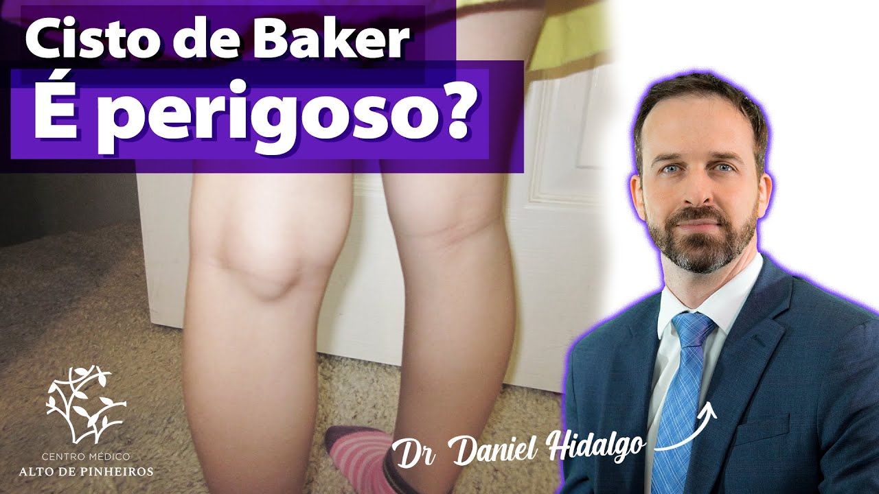 Cisto de Baker o que é? Como tratar? | Dr. Daniel Hidalgo - YouTube