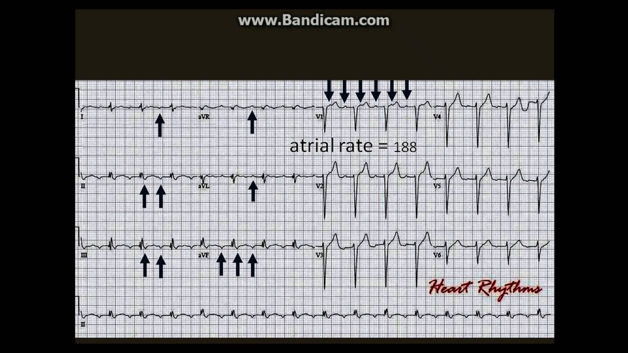 A Challenging Rhythm: AT or AFL - YouTube
