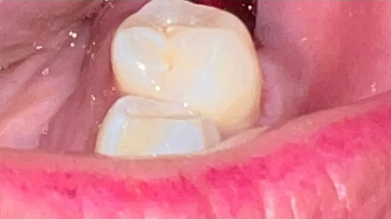 Hey Doc, What’s a Dry Socket? - YouTube