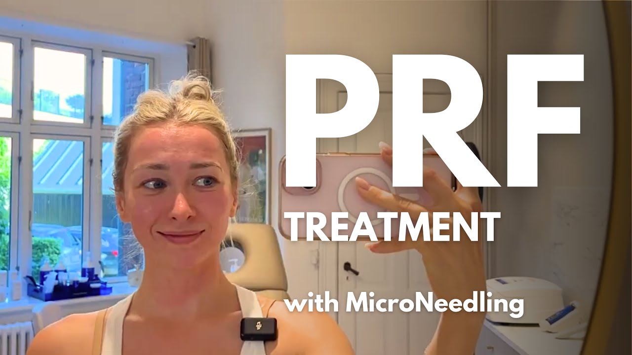 PRF Face Treatment + Microneedling: Full Process & 48-Hour Results ...