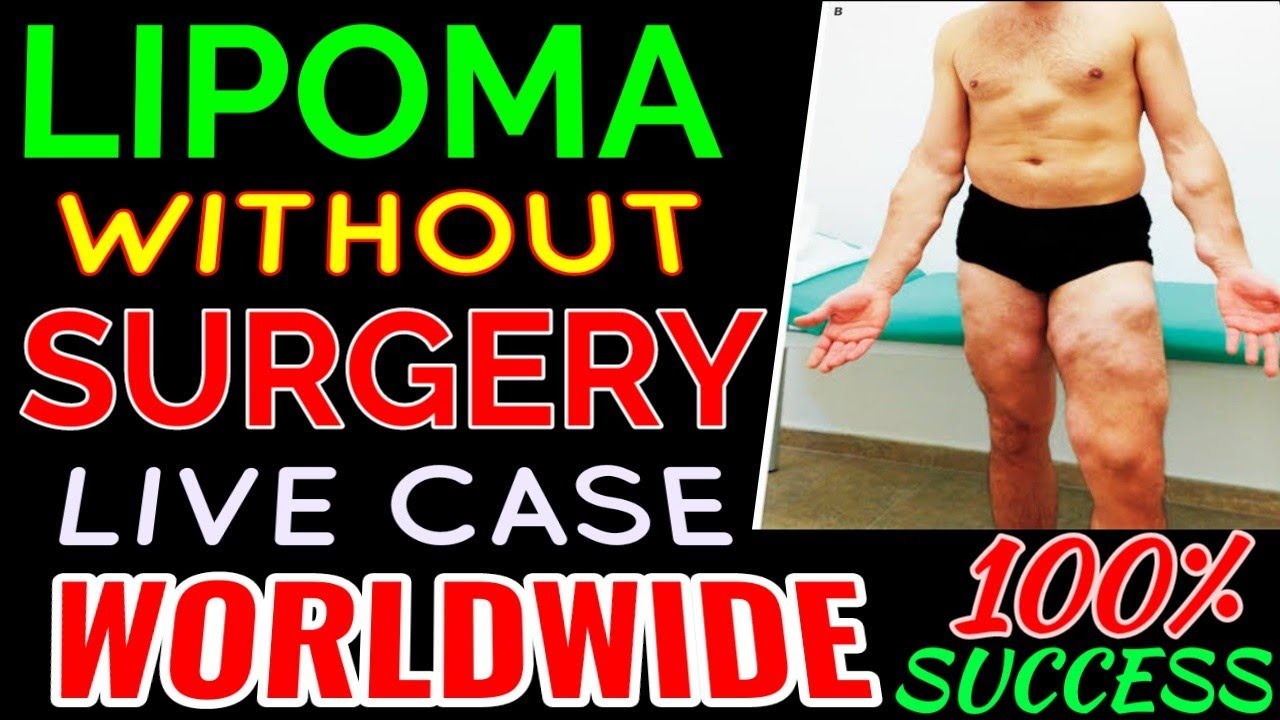 LIPOMA treatment / lipoma treatment without surgery / चर्बी की गांठ का ...