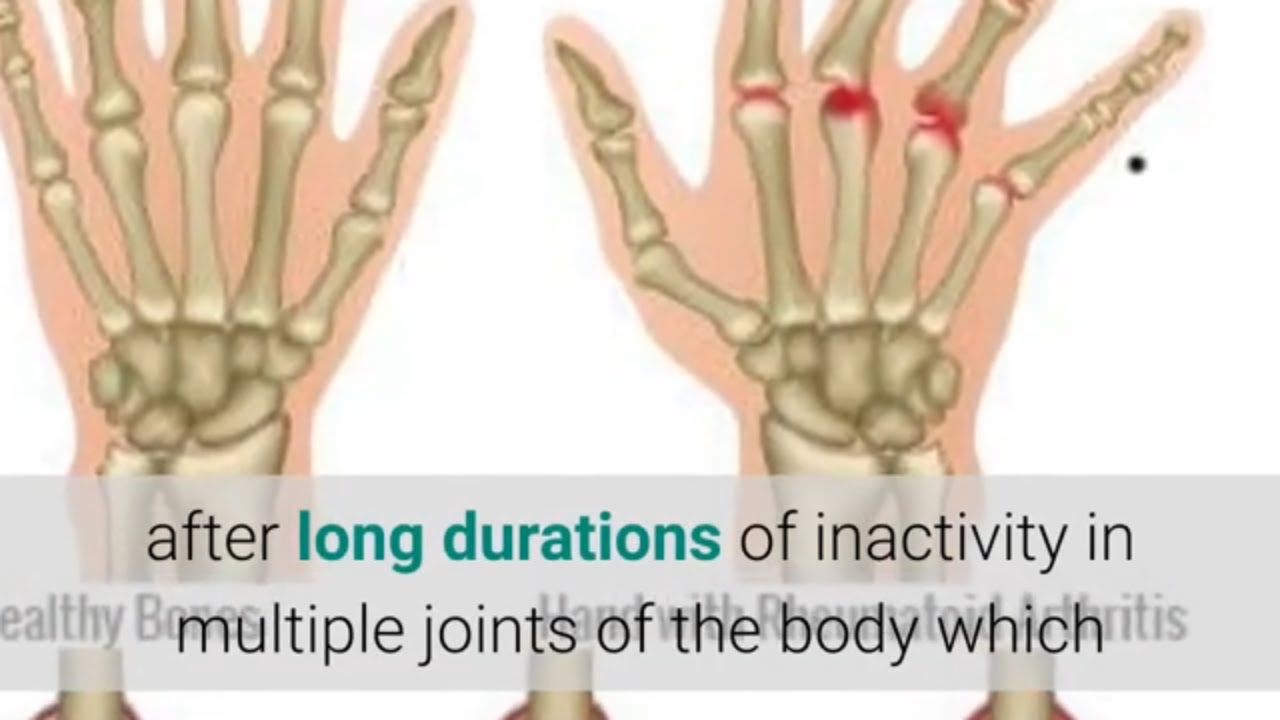 Inflammatory Polyarthritis Definition - YouTube