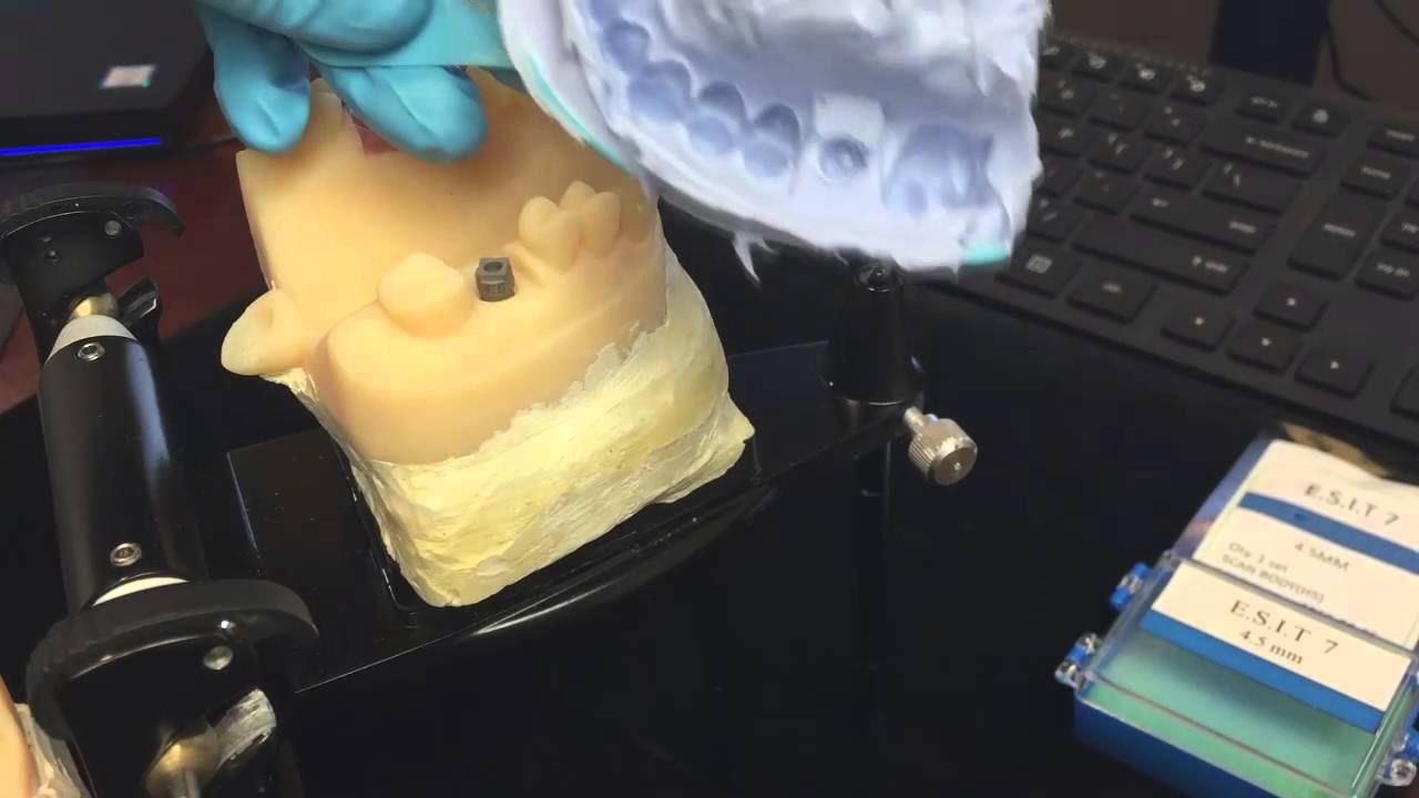 Implant Scan Body - impressions with E.S.I.T. - YouTube