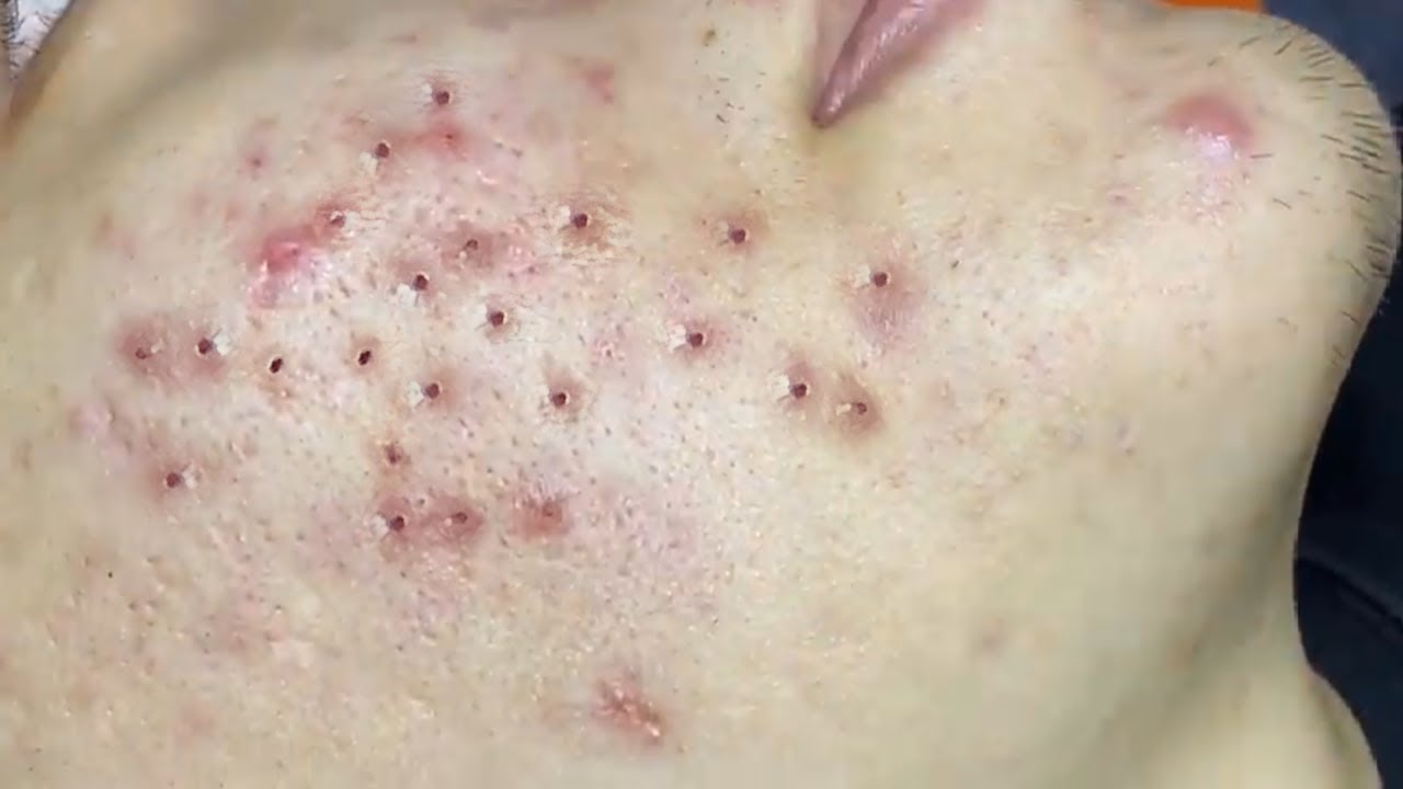 Loan Nguyen Acne Treatment 15u - YouTube