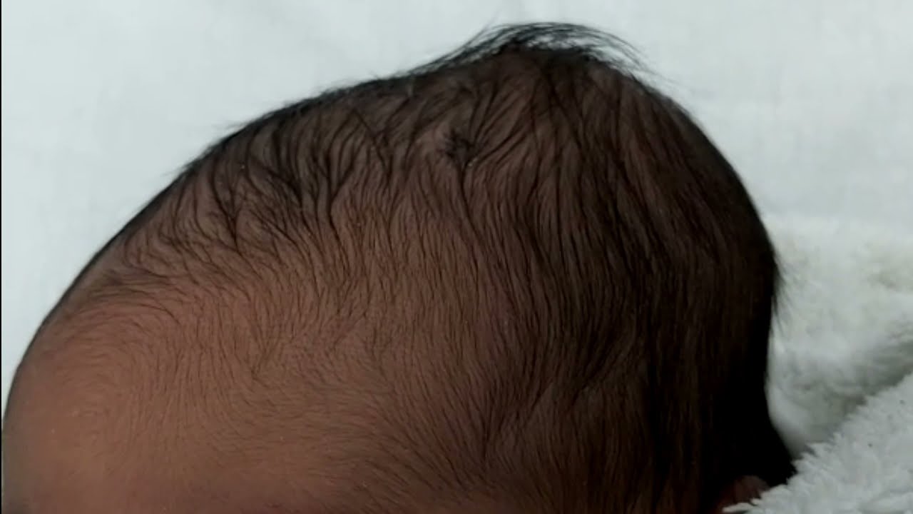 Case 635 Scaphocephaly, dolichocephaly, sagittal craniosynostosis ...