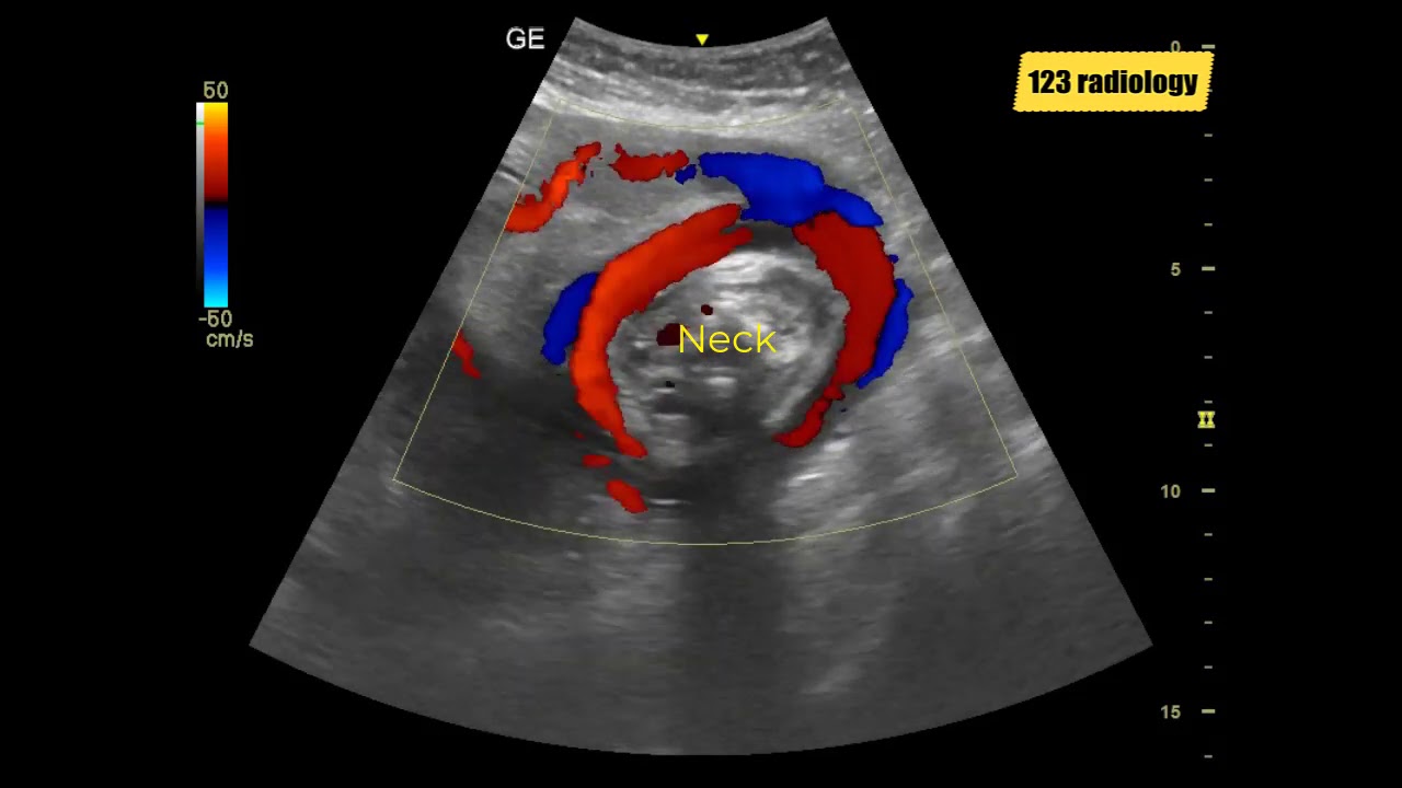 Umbilical Cord Around Fetal Neck YouTube