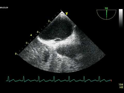 PFO : PATENT FORAMEN OVALE TOE / Foramen oval permeable ETO ...