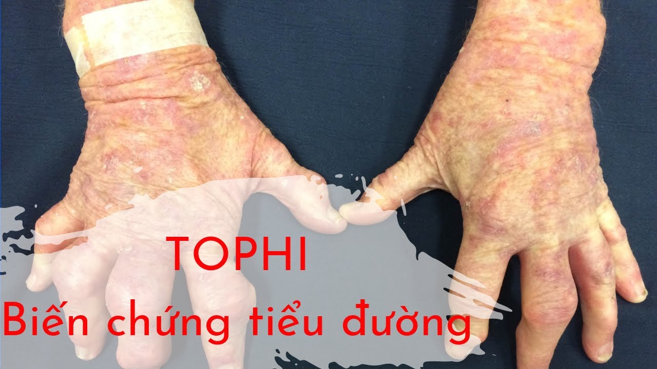 Tophi (Tophy) Biến chứng nguy hiểm của bệnh gout (gút) - YouTube