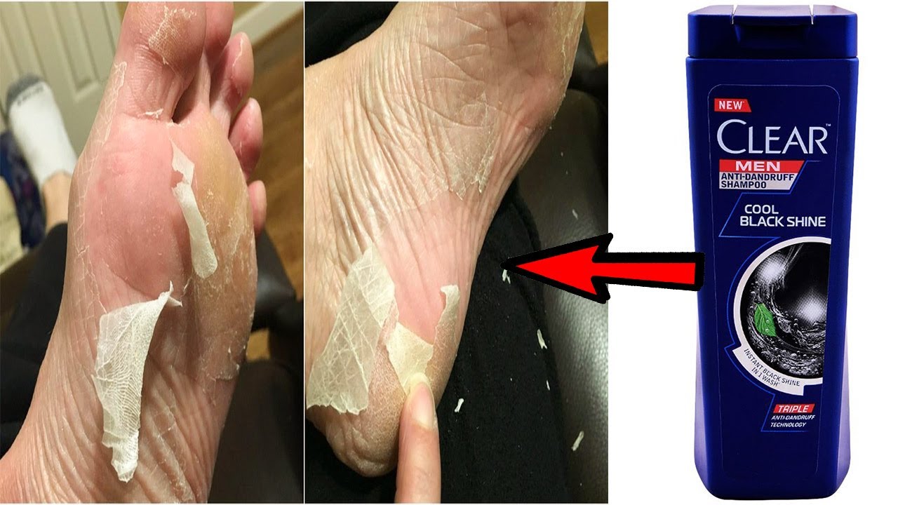 Aloe vera and clear shampoo foot mask peels off dead skin | The Skin ...
