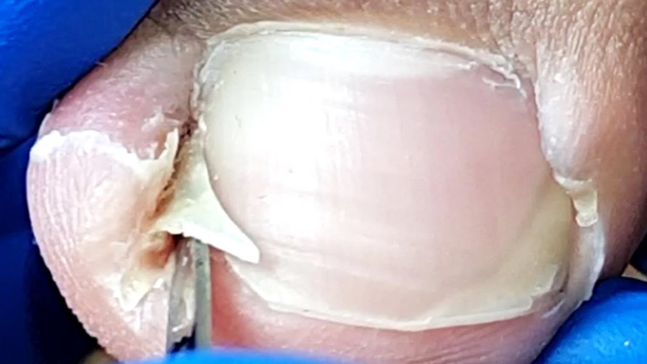 Repair sharp ingrown armor! Carefully pull it out【Xue Yidao Pedicure ...