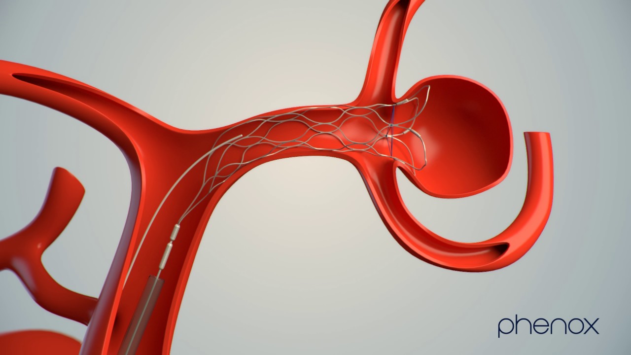 phenox | pCONUS | Bifurcation Aneurysm Implant - YouTube