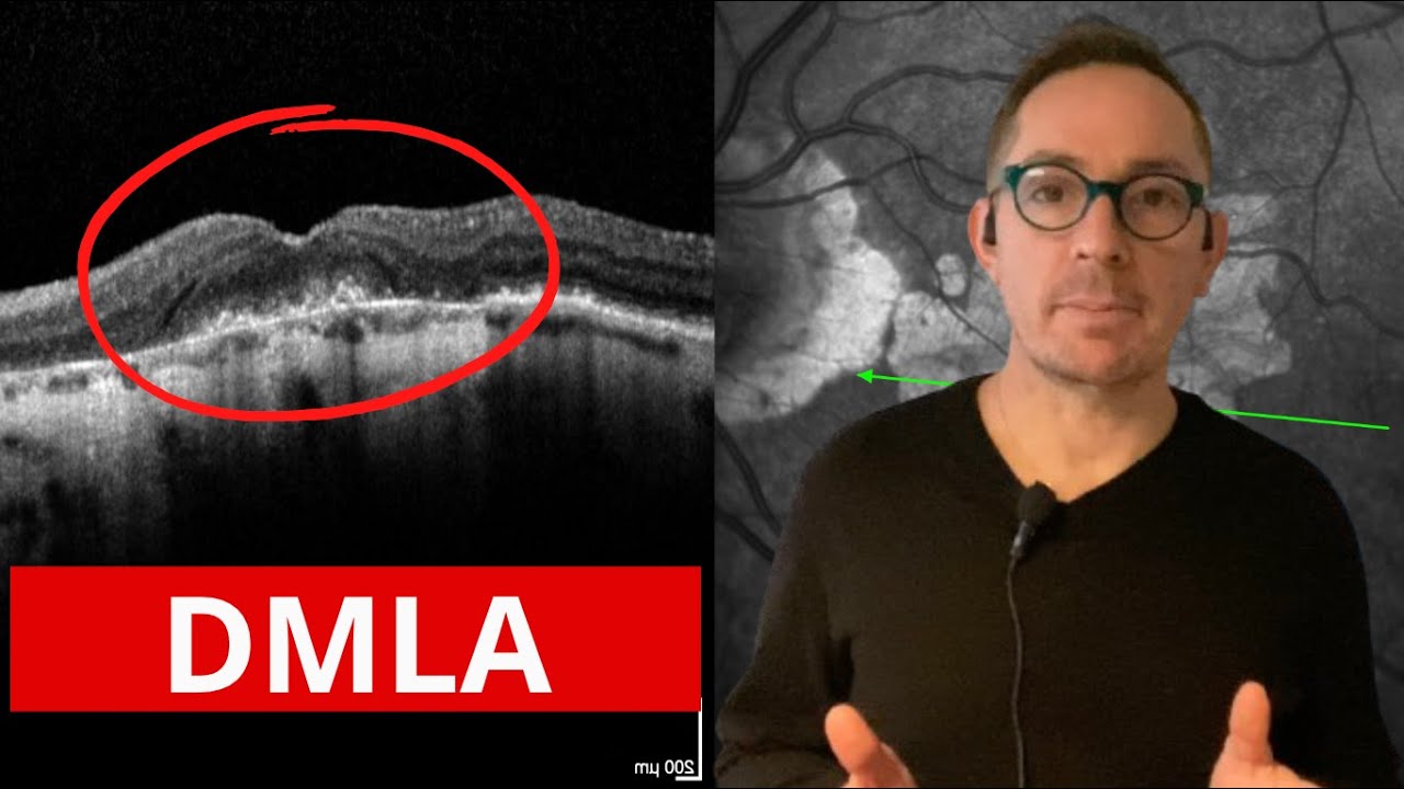 La DMLA et ses Solutions (Maladie des yeux) - YouTube