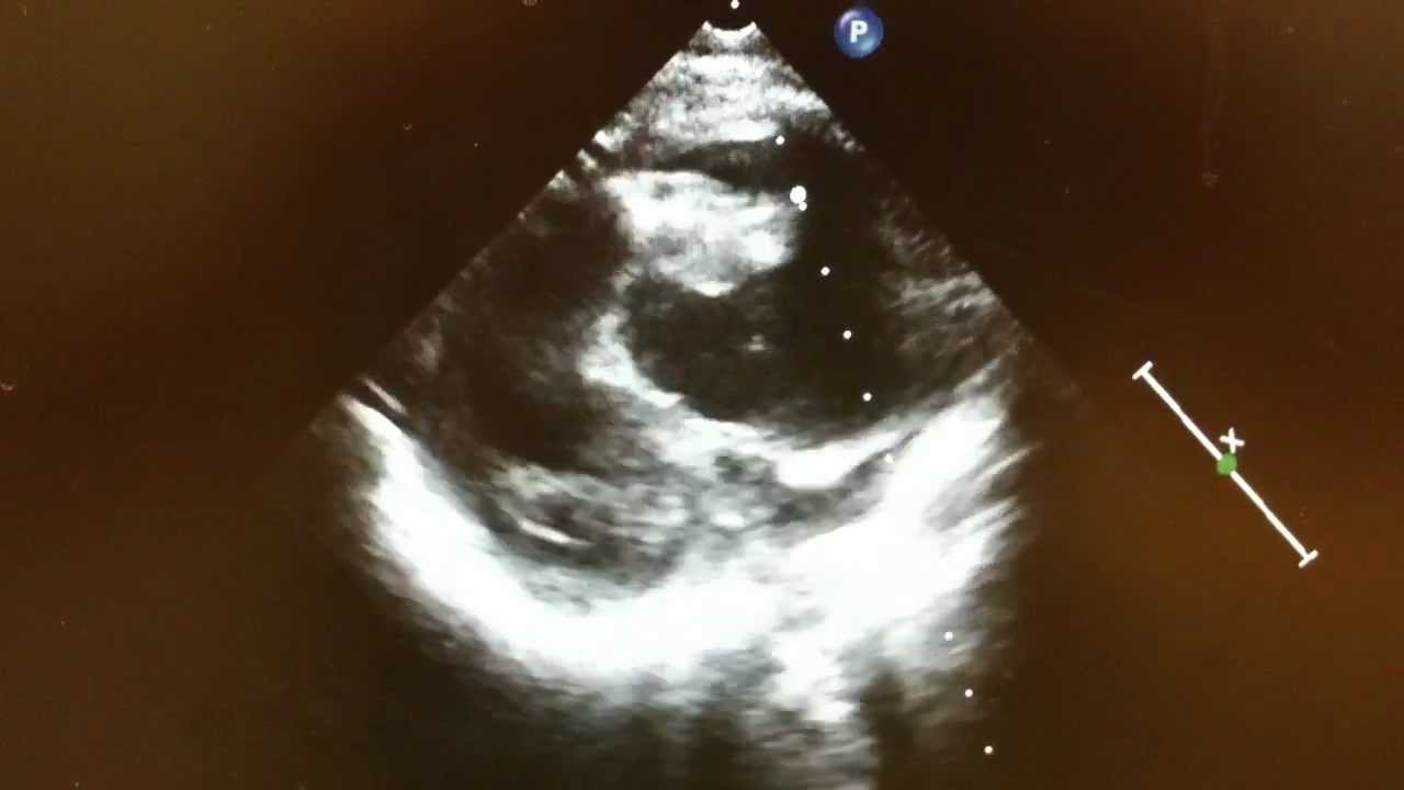 RV dilatation in PE - YouTube