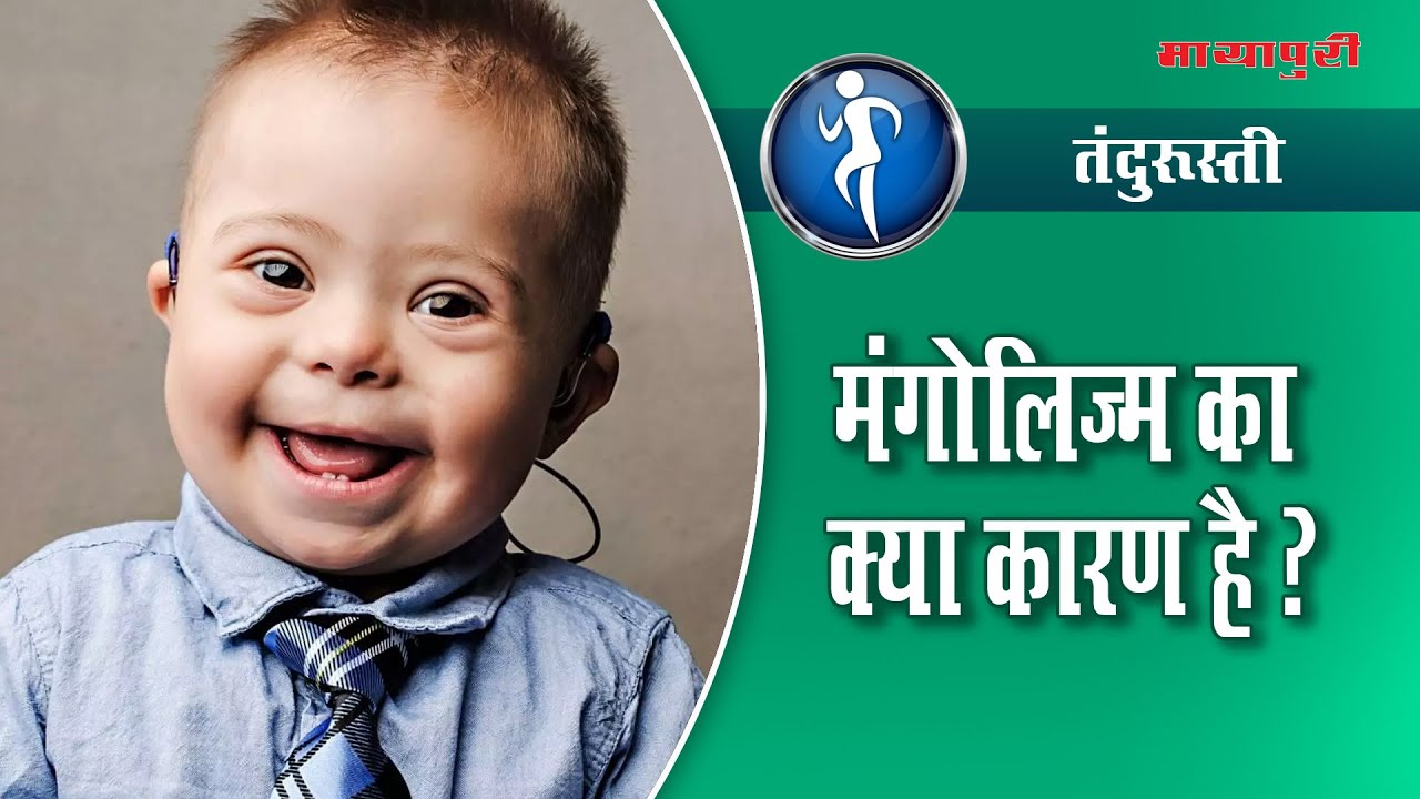 Mongolism Explained !! Down Syndrome Children in Hindi | Tandrusti Dr ...