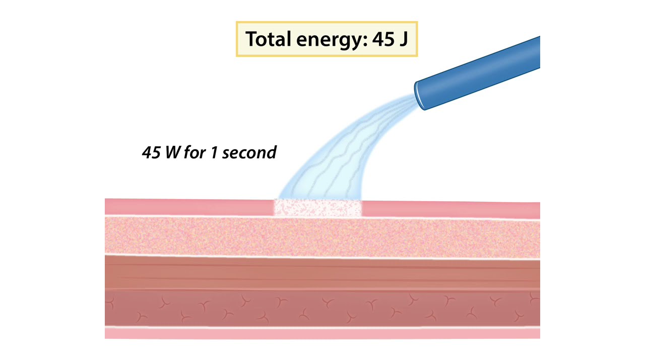 HCC 1472 -Lesson-11b1-Hemostatic Devices APC - YouTube