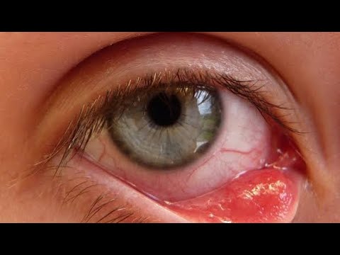 Stye | eyelid boils explained indetail @eyecareoptom5506 #eye #eyelid # ...