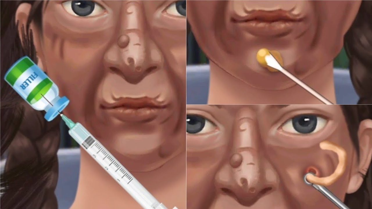 asmr Remove 😀Big Acne & Worm Infected Girl FACE: ASMR Deep Cleaning ...