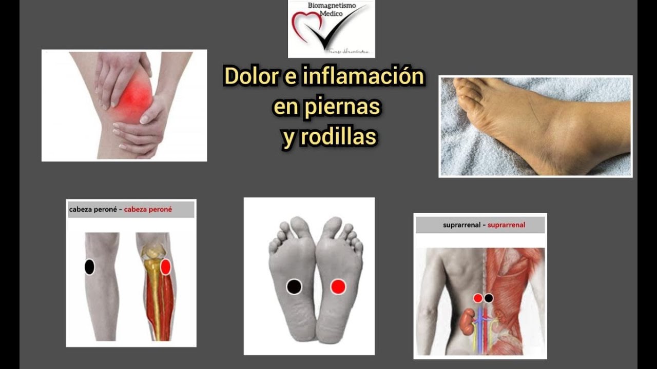 Terapia de IMANES: Protocolo para dolor e inflamación en piernas y ...