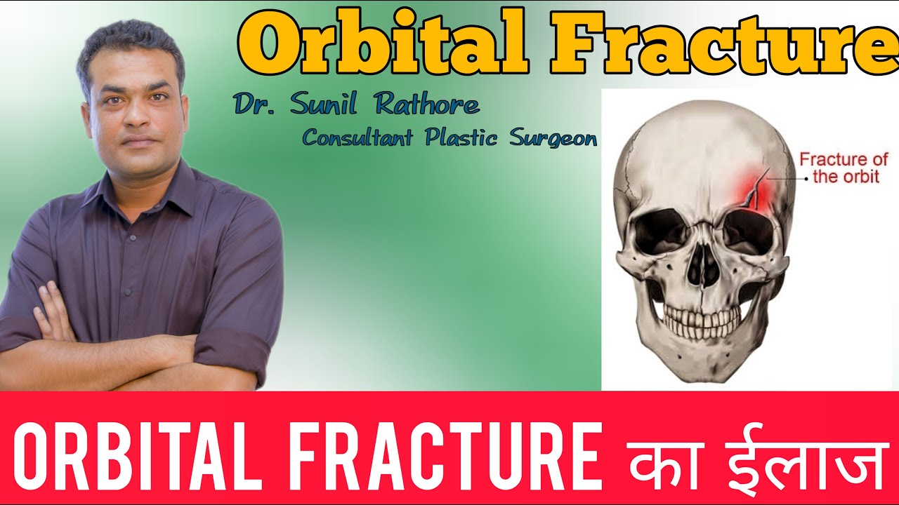 Orbital Fracture - Signs, Symptoms, Diagnosis & Treatment | orbital ...
