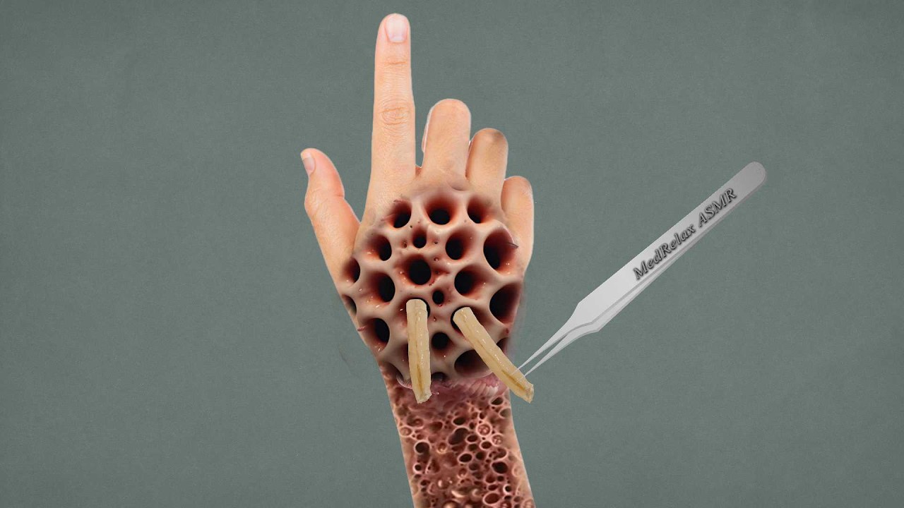 ASMR Animation treatment from infected Hand palm | deep cleaning ...