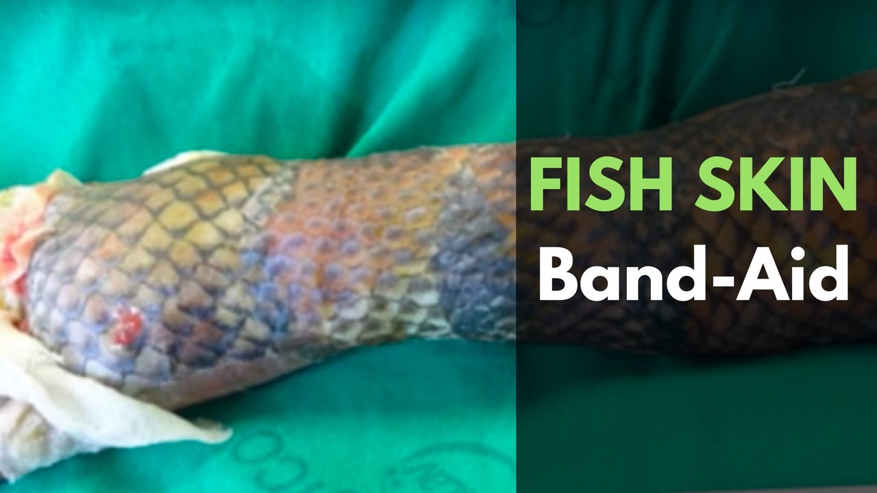 Giant Fish Skin Band-Aid! - YouTube