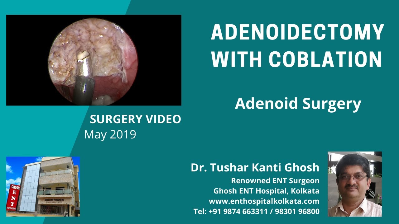 Adenoidectomy in Kolkata India - With Coblation - Best Result - Surgery ...