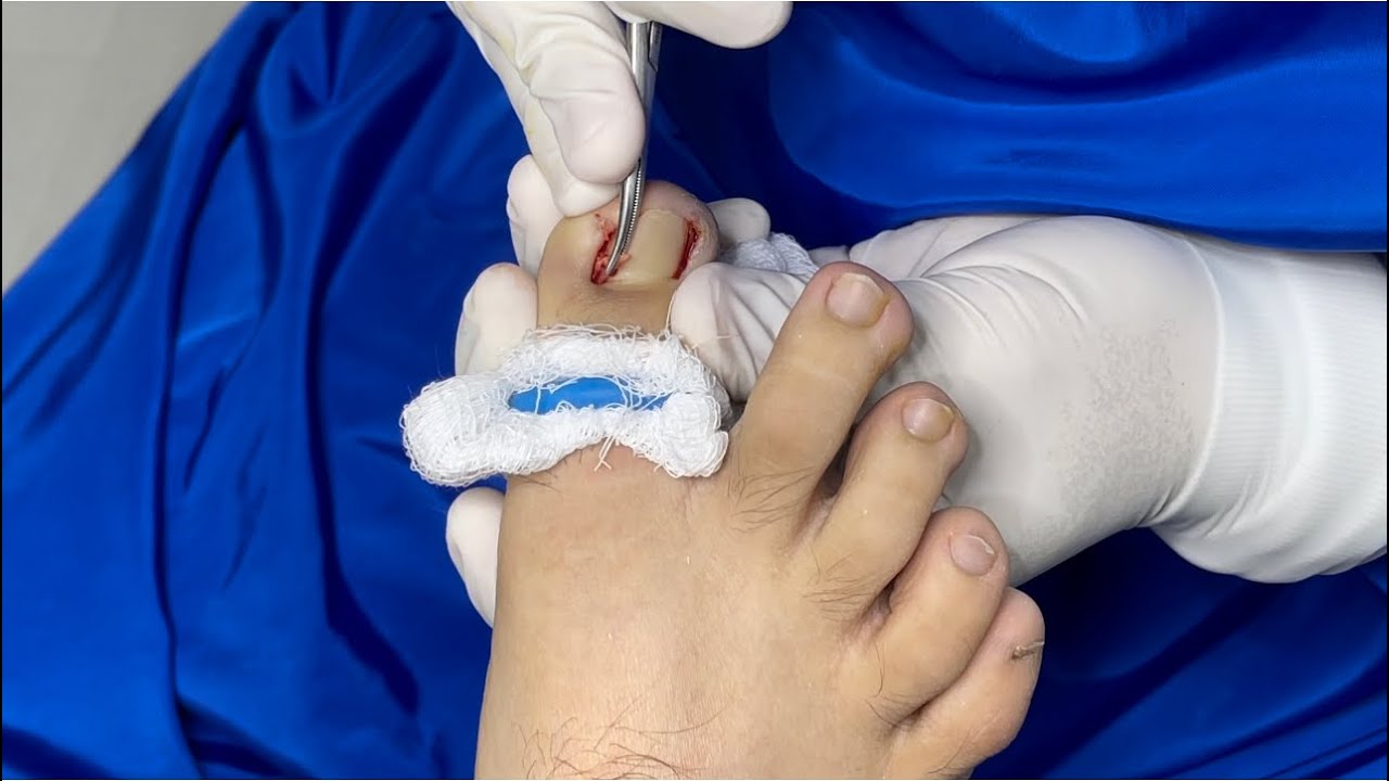 MATRICECTOMIA QUÍMICA BILATERAL🦶🏻 solución definitiva para uñas ...