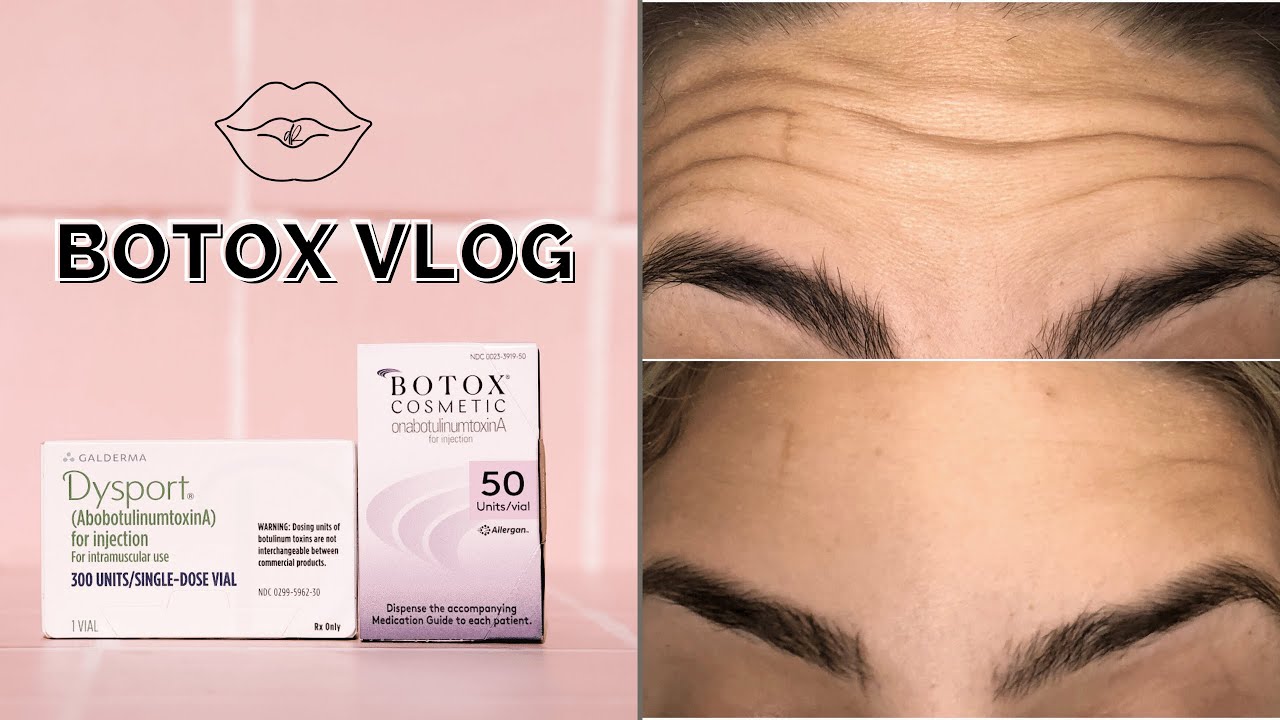 Botox Vlog- Deux Rosé Beauty Refinery - YouTube
