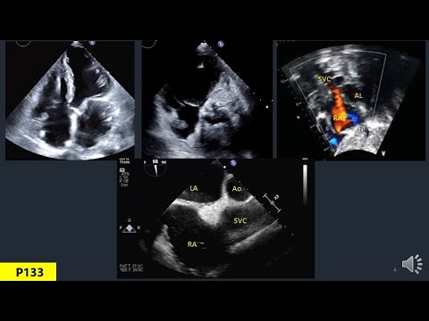 Anatomy Of Heart In Echo Part 6: Right Atrium - YouTube