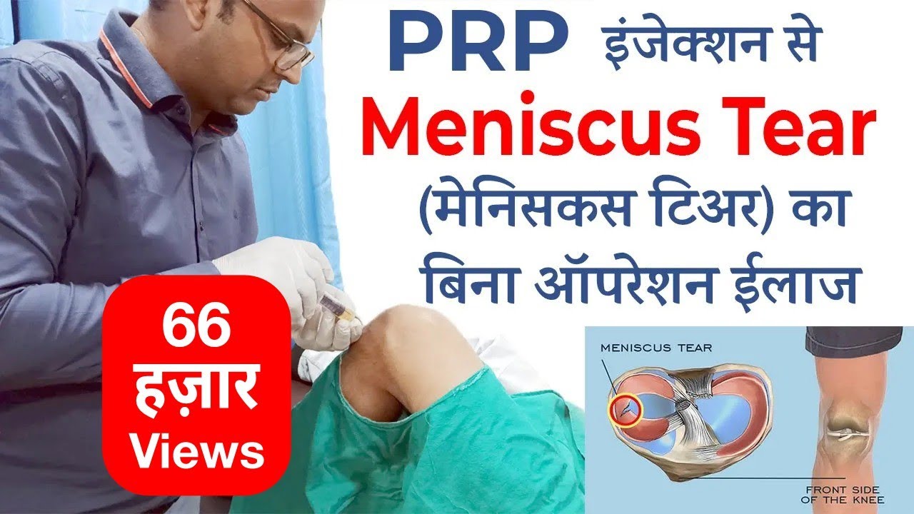 Meniscus Tear का बिना ऑपरेशन ईलाज PRP Injection se | By Dr. Sunil Saini ...