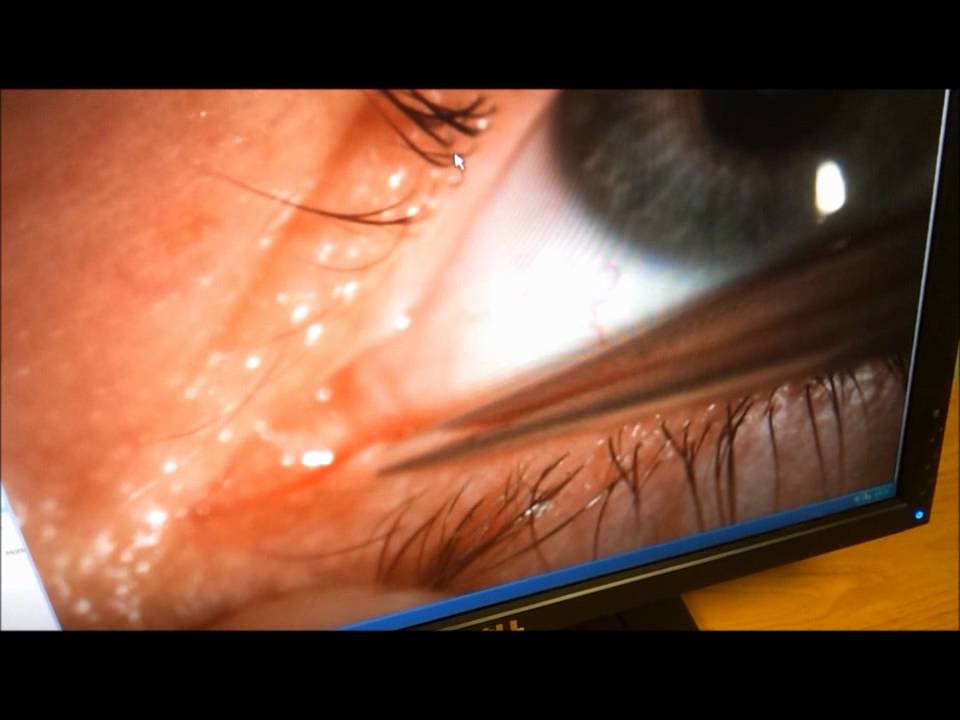 punctal plug removal YouTube punctal-plug-removal-youtube