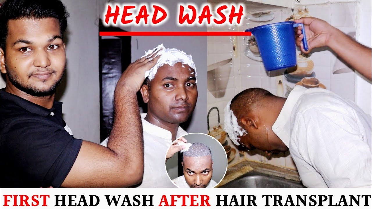 First Head wash After Hair Transplant in India 2023 | Best Head Wash ...