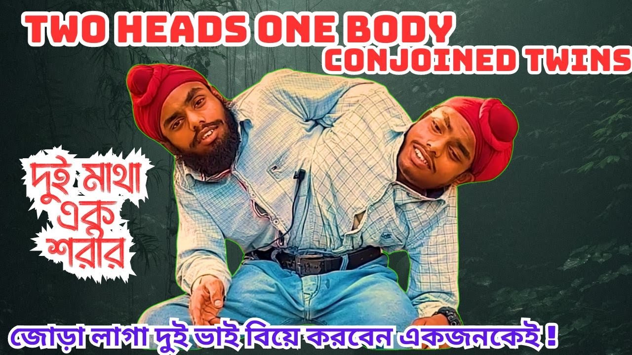 TWO HEADS ONE BODY .CONJOINED TWINS .দুই মাথা এক শরীর ! সোহনা মোহনা ...