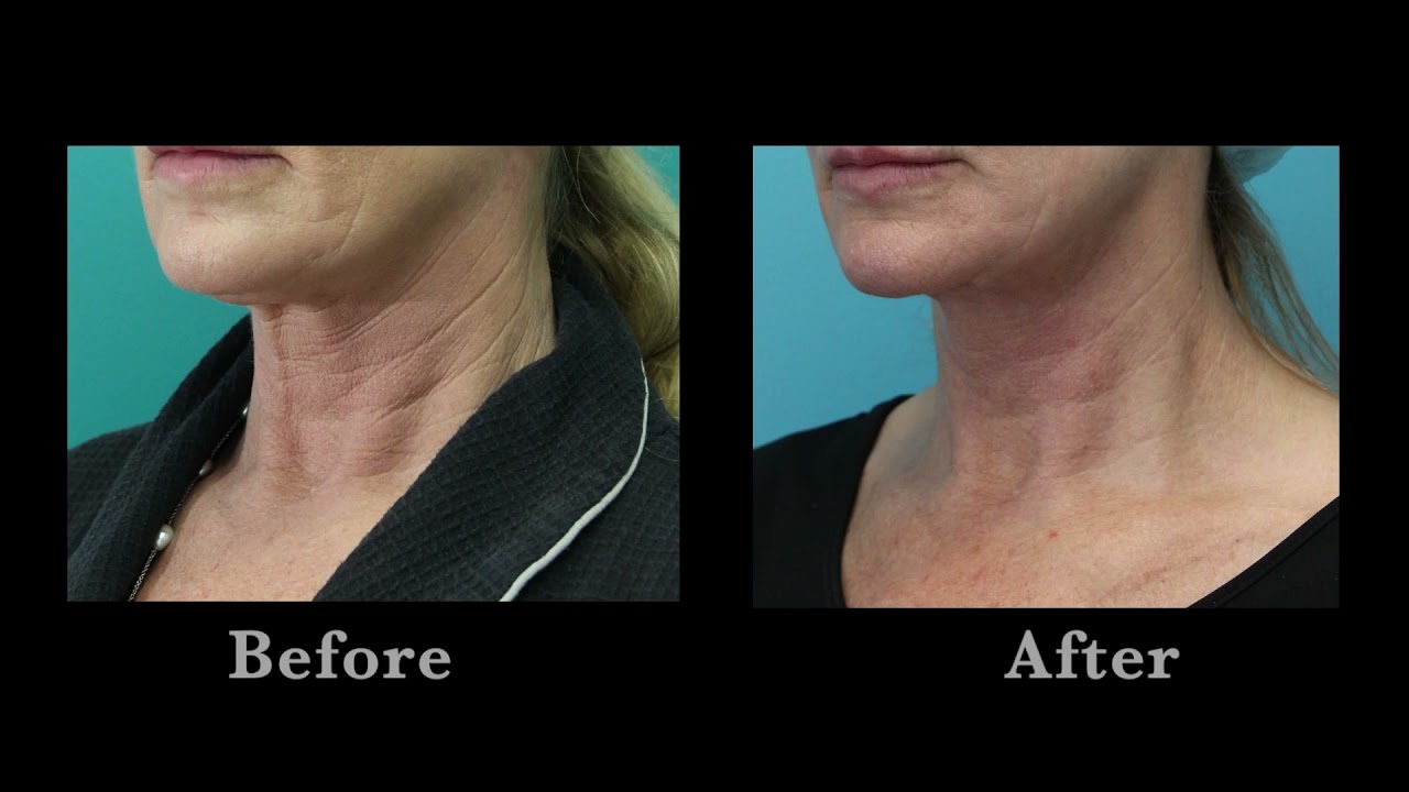 Erbium Resurfacing Laser Treatment for the Neck - YouTube