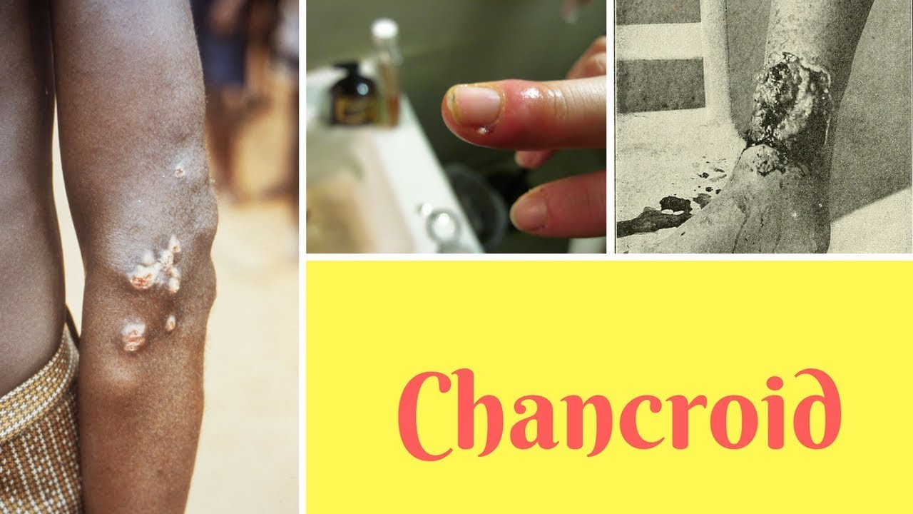 What is a chancroid - YouTube