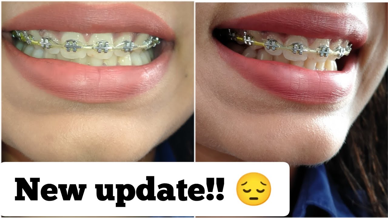 New update 😮!!! 3-years changes in teeth # braces#howto#teeth#doctor ...