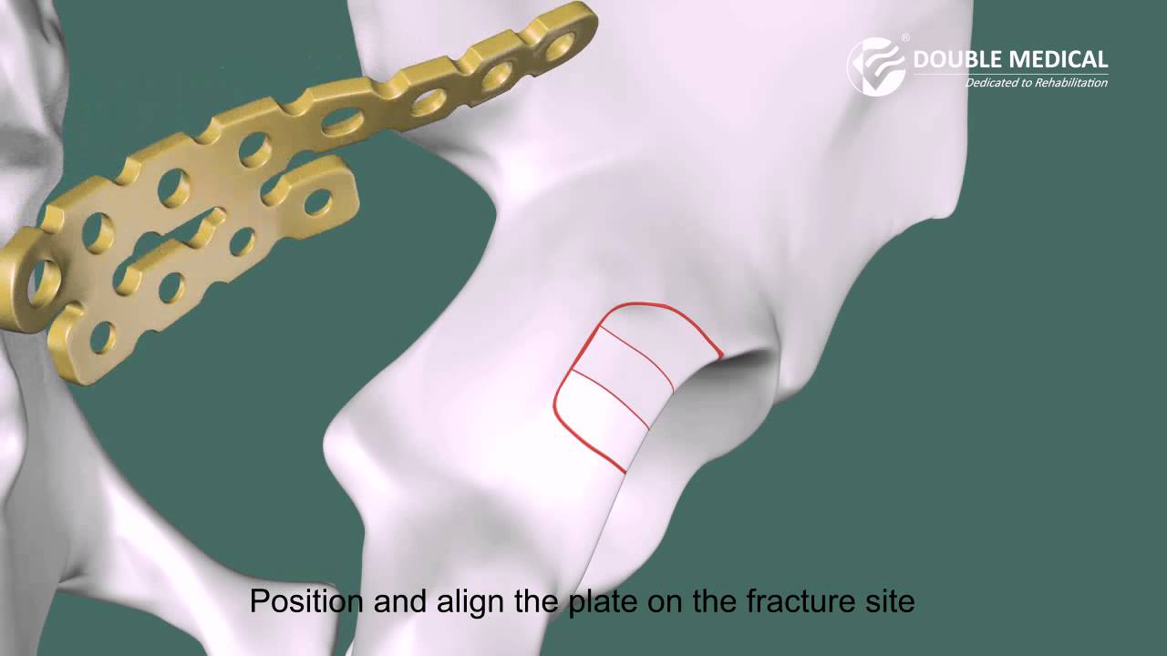 Posterior Pelvic Acetabular Plate - YouTube
