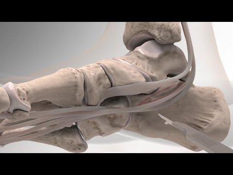 Flatfoot Repair With the InternalBrace™ Ligament Augmentation Procedure ...