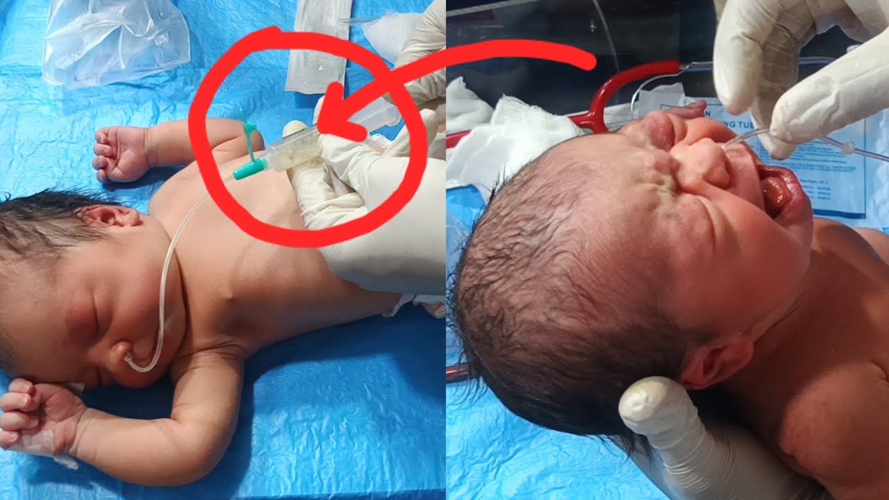 Newborn Stomach Wash | NG Tube Insertion & Gastric Content Aspiration ...
